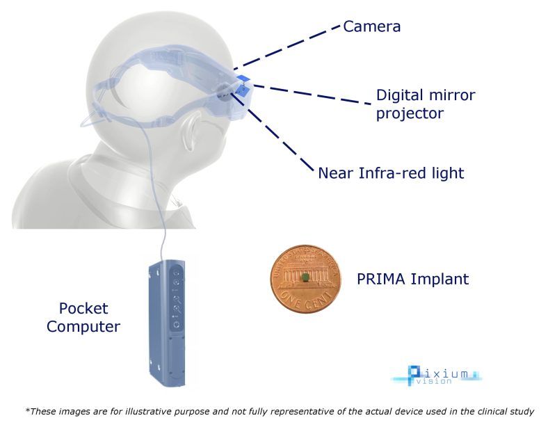 Neuralink’s competitor restored eyesight in blind patients with this ...